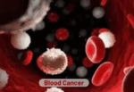 Blood Cancer Treatment | Types, Procedure, & Expert Care